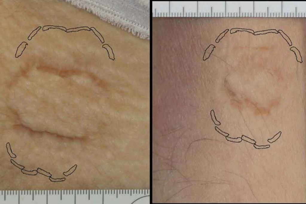 Forensic Bitemark Analysis for Court Trials is Not Supported by ...